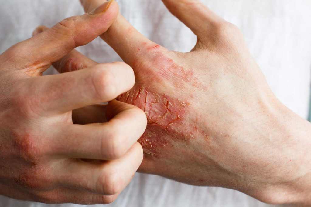 Neurodermitis im Genitalbereich: Behandlungsmöglichkeiten und Vorsorge ...